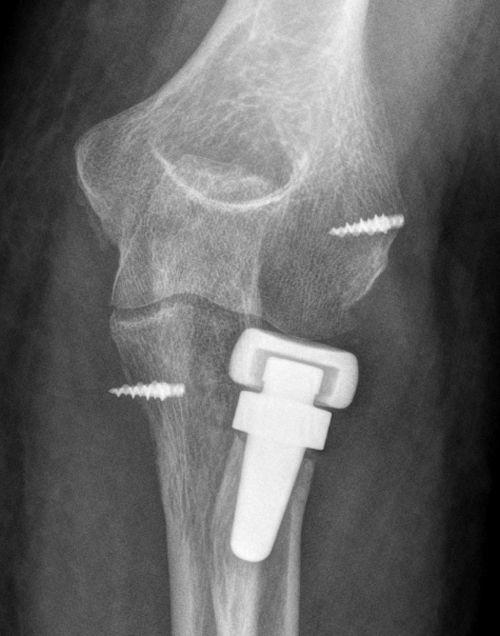 Medium term results of unipolar modular radial head arthroplasty ...