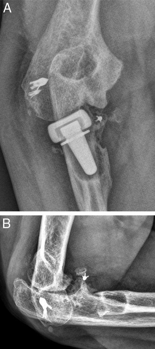 Medium term results of unipolar modular radial head arthroplasty ...