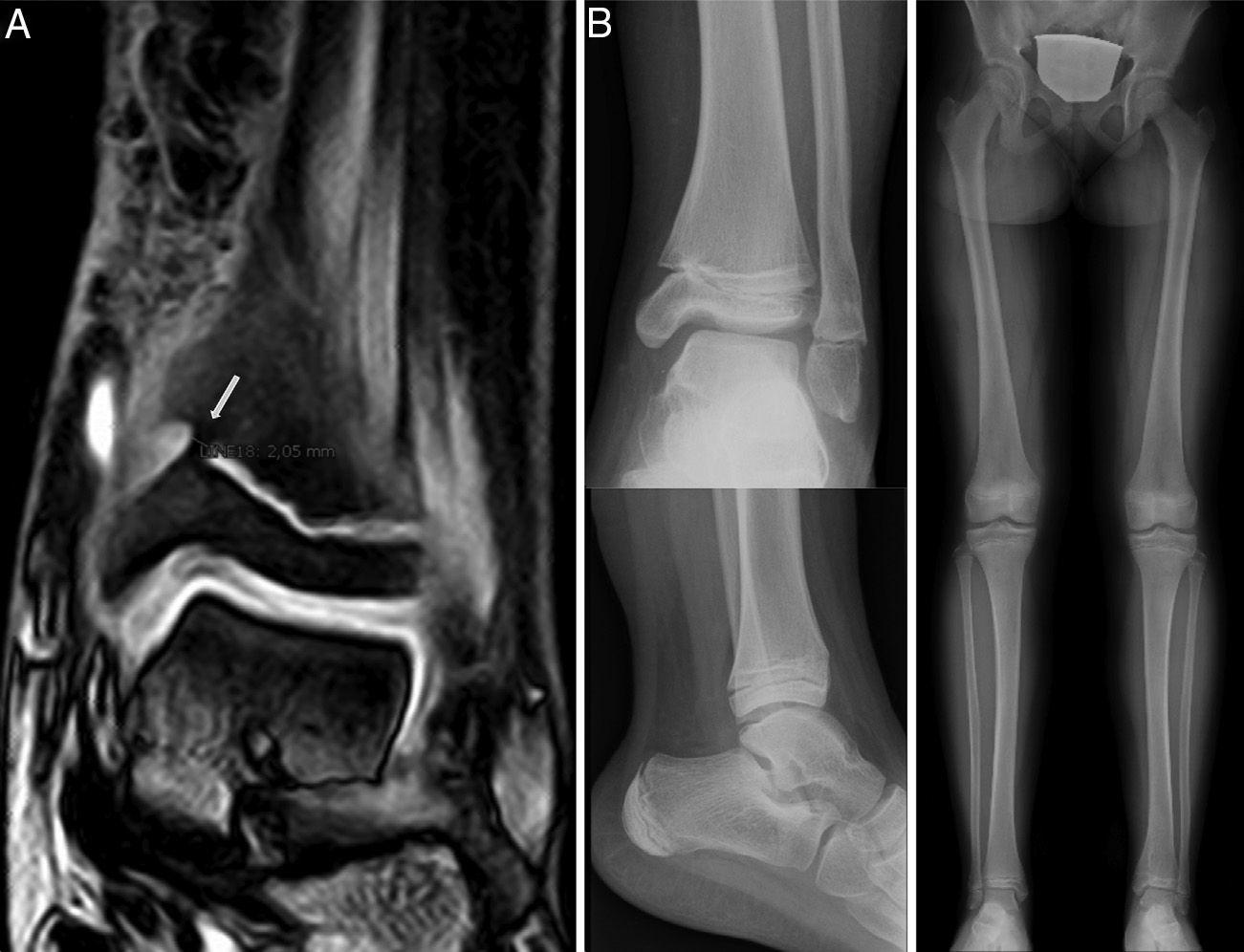Arthroscopy-assisted resection–interposition of post-traumatic central ...