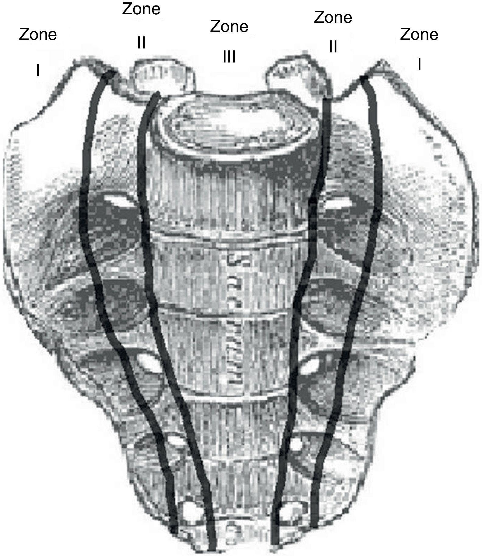 Sacral fracture with spino-pelvic dissociation: A literature review ...