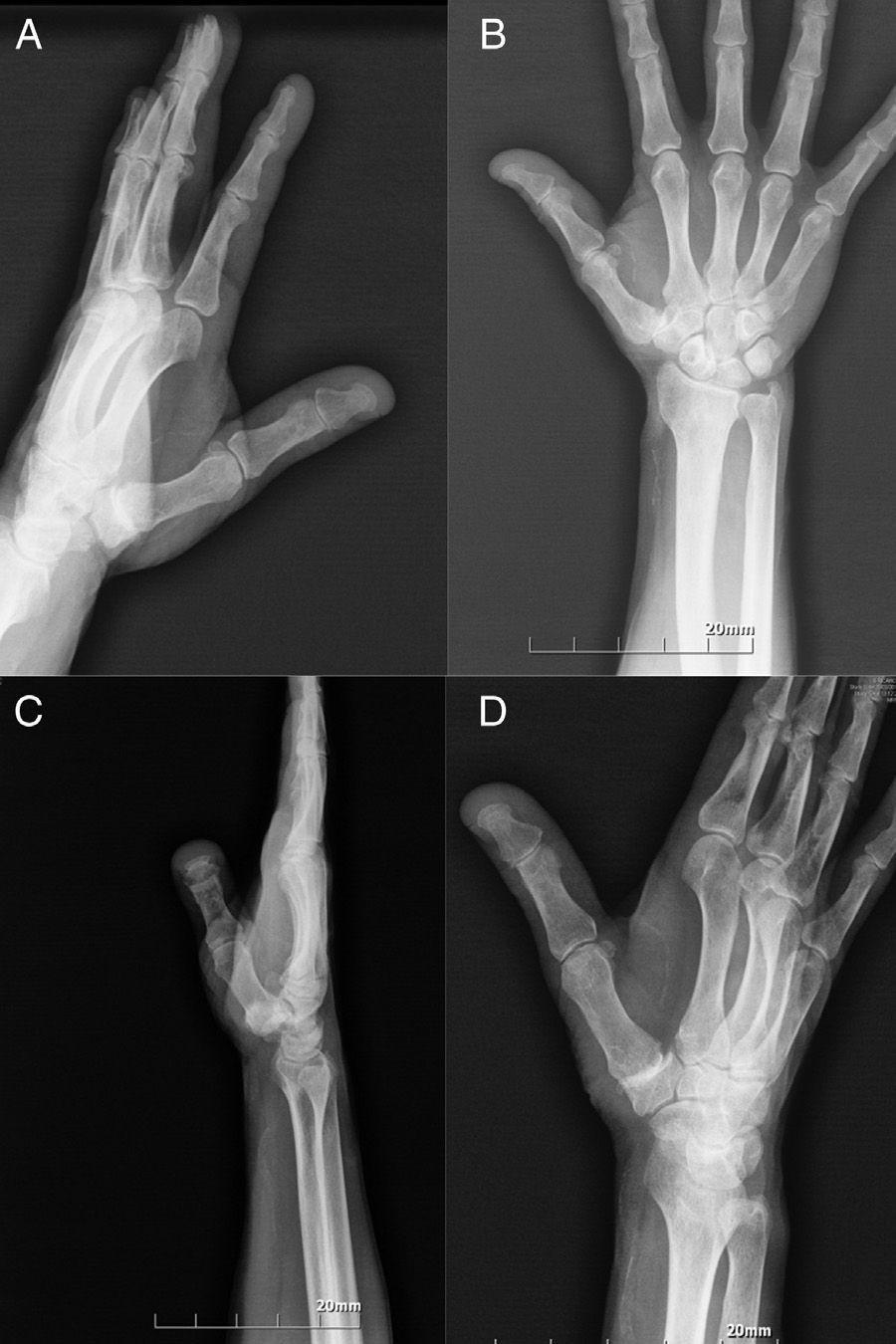 Inter-observer agreement on the Eaton–Littler classification of ...