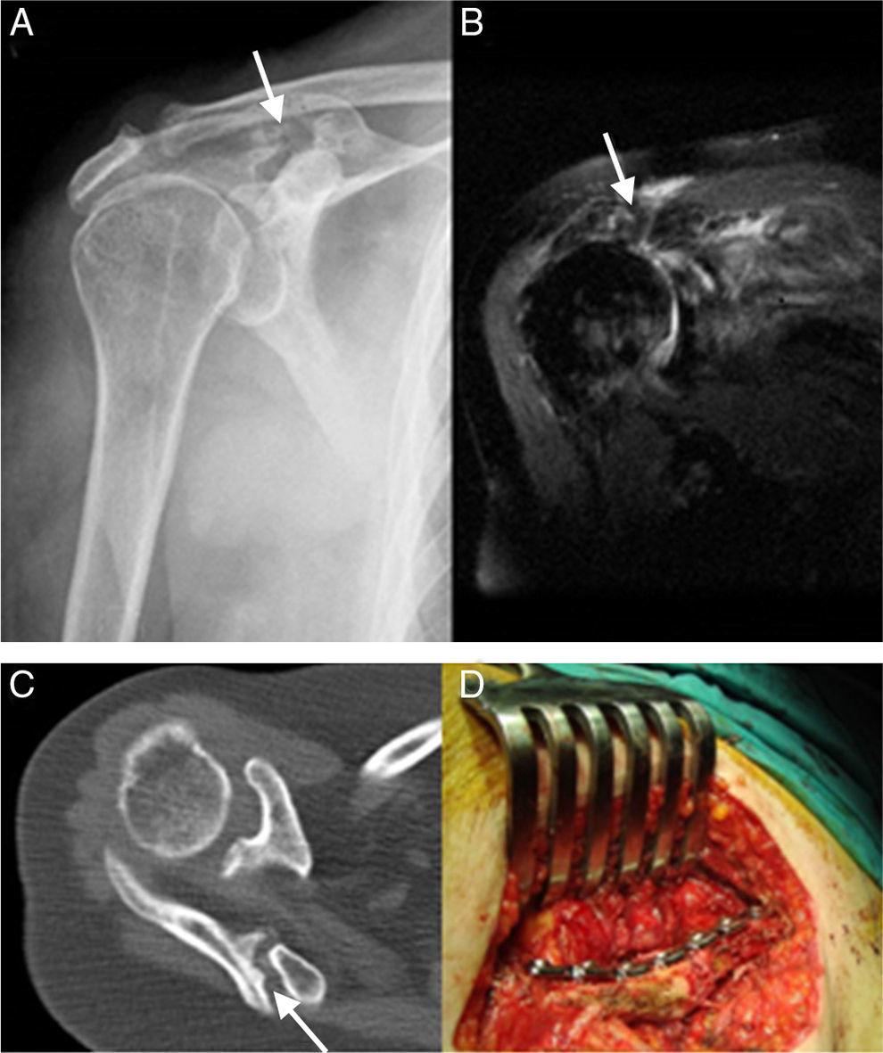 Stress fracture of the scapular spine associated with rotator cuff ...
