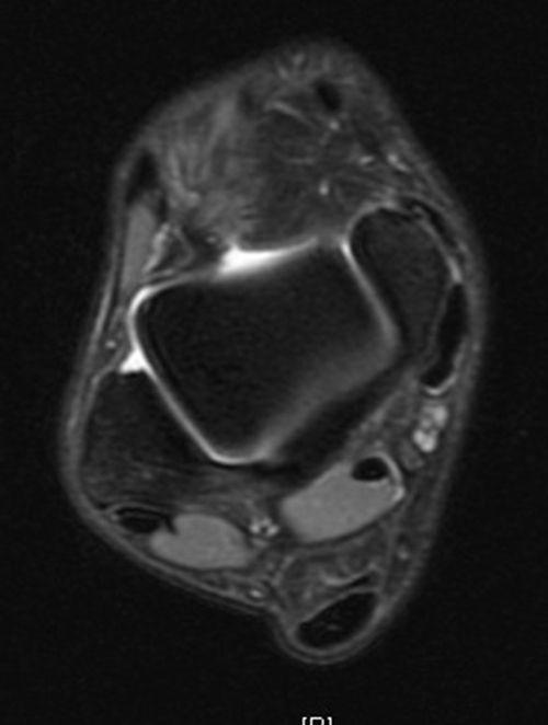 Traumatic dislocation of posterior tibial tendon by avulsion of flexor ...