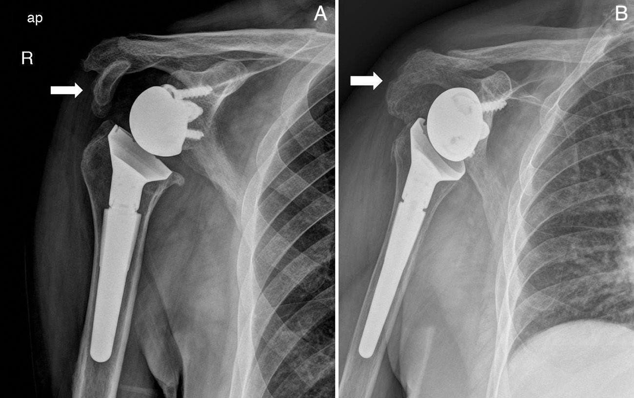 Scapula insufficiency fractures after reverse total shoulder ...