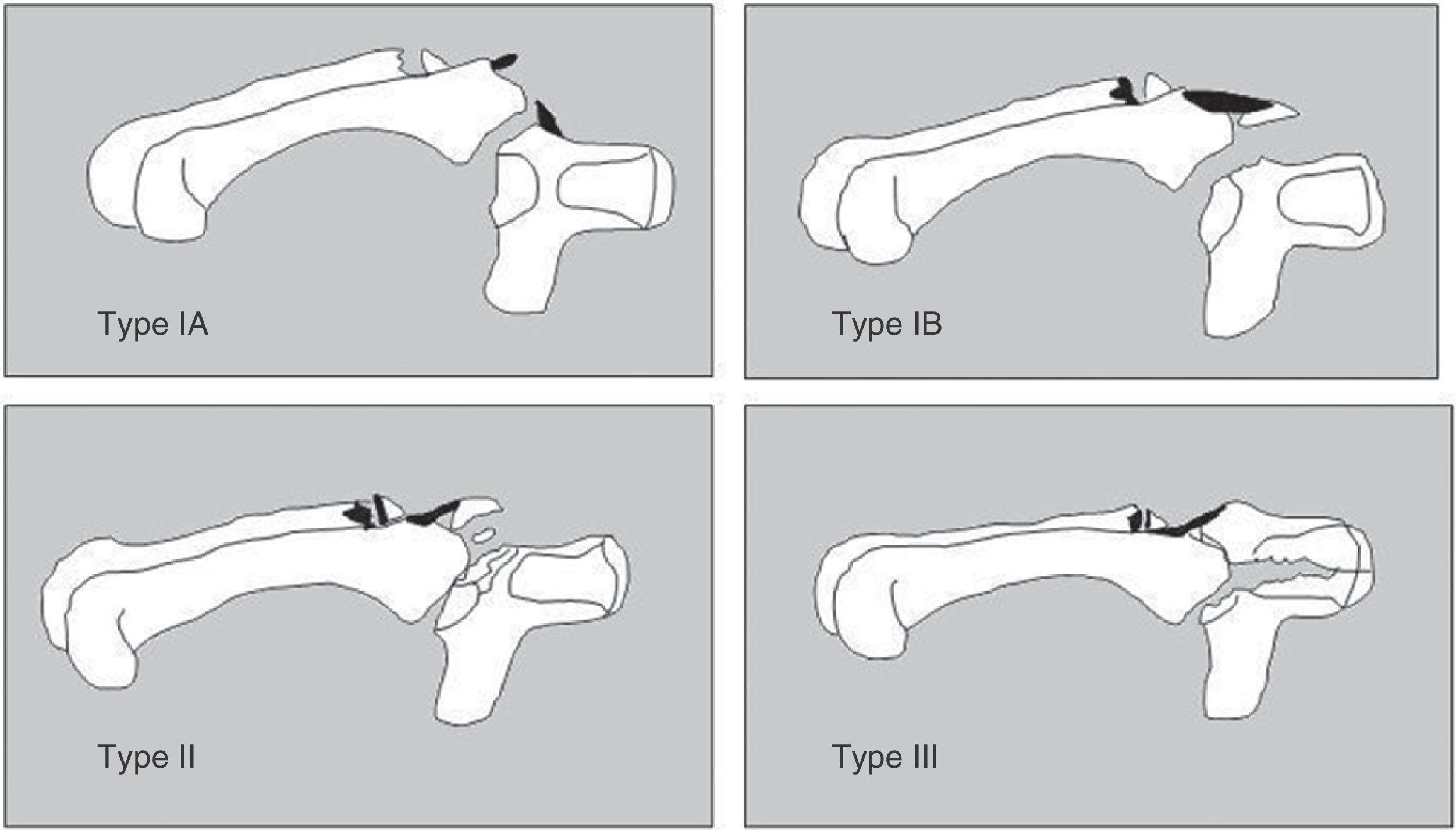 Hamate fractures | Revista Española de Cirugía Ortopédica y ...
