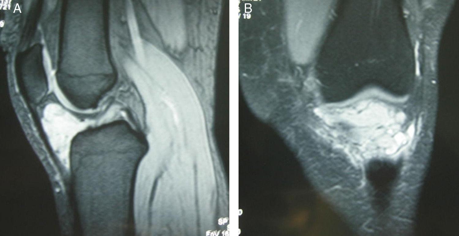 Extensor mechanism allograft and radiotherapy in the treatment of soft ...