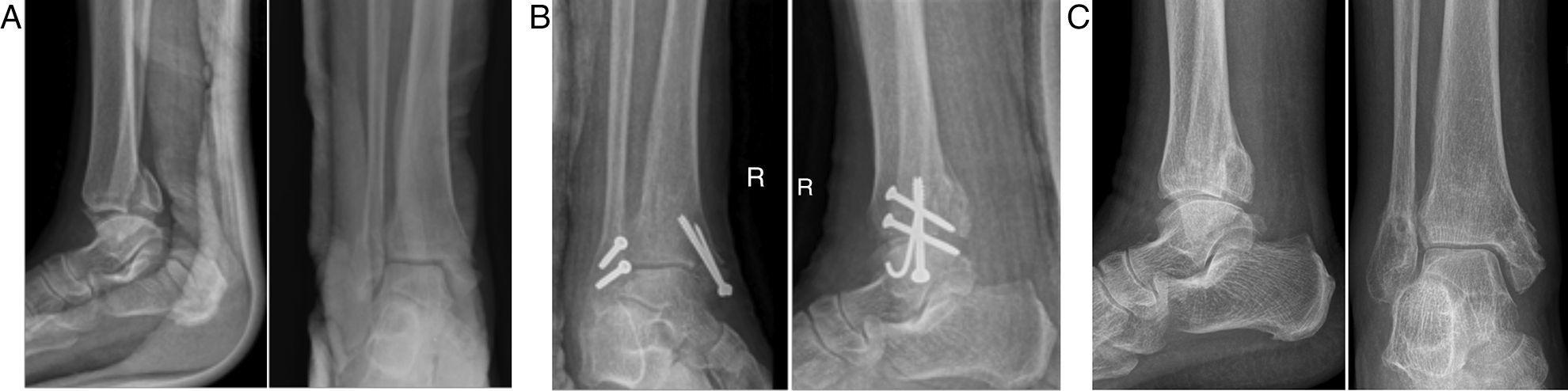 Open reduction and internal fixation of displaced ankle fractures in ...