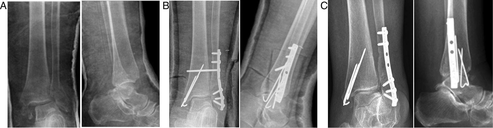Open reduction and internal fixation of displaced ankle fractures in ...