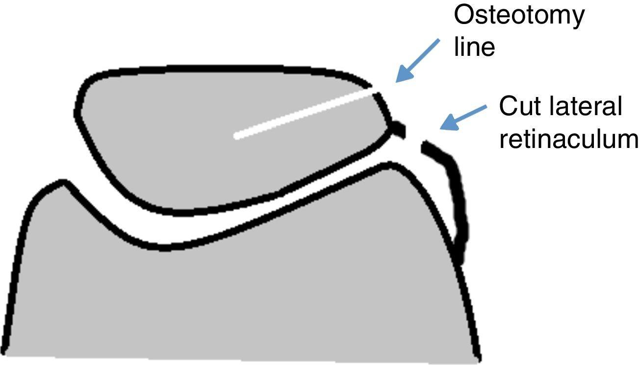 Coronal patellar osteotomy of the external facet combined with the ...