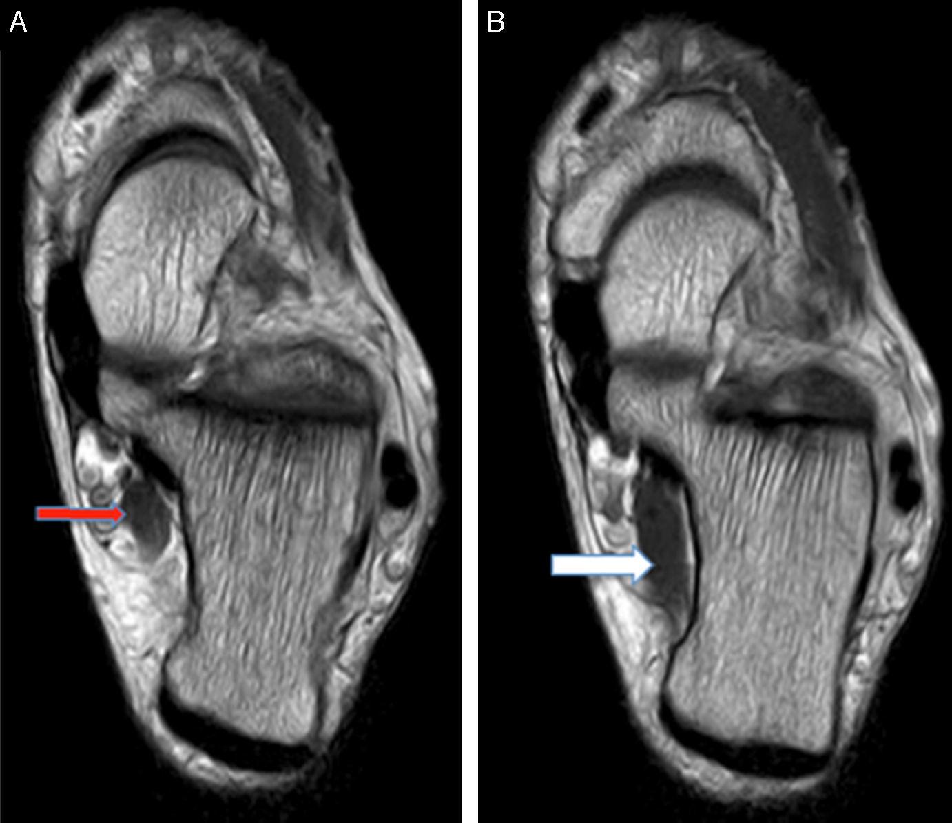 Tarsal Tunnel Syndrome Mri