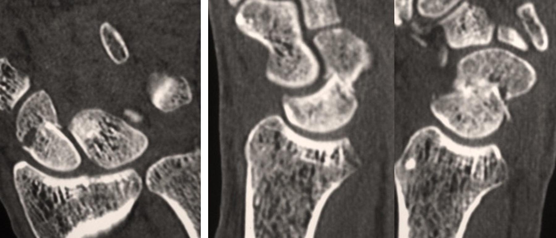 Arthroscopic reconstruction for unstable scaphoid non-union | Revista ...