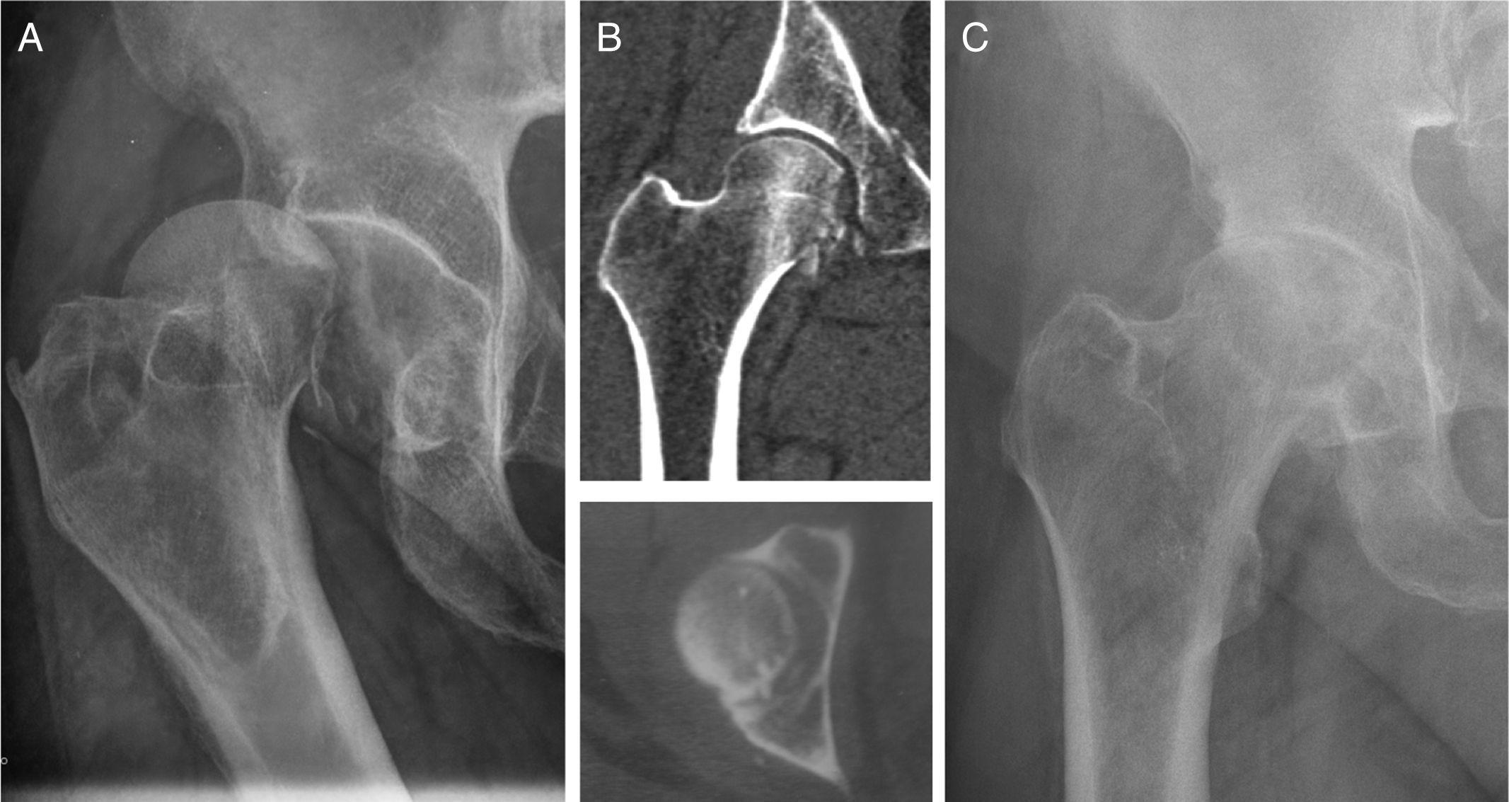 Prognostic factors after a traumatic hip dislocation. A long-term ...