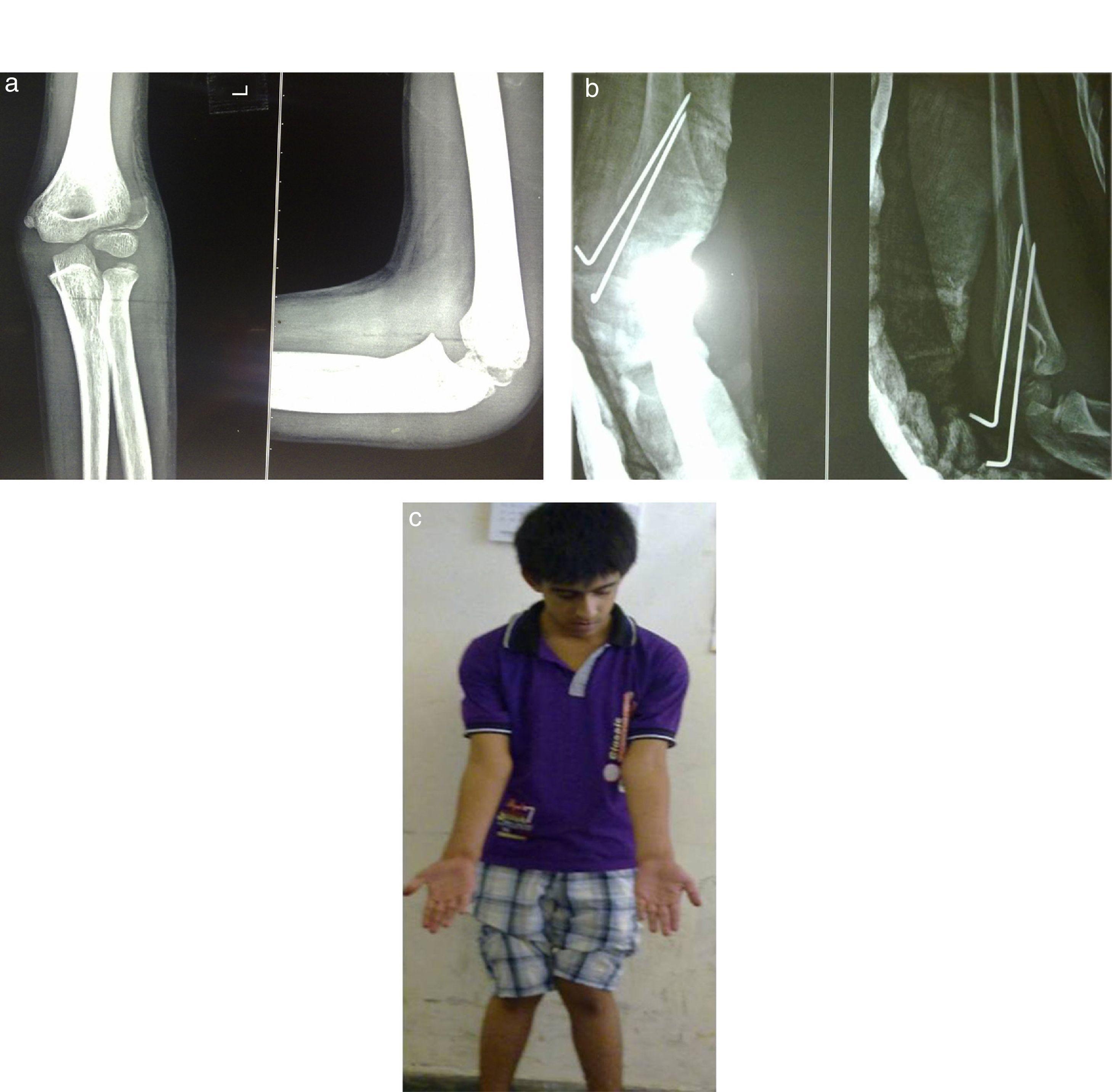 Fishtail Deformity Lateral Condyle Fracture