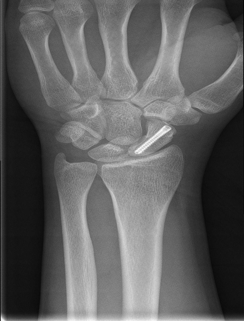 Scaphoid fractures treated with a volar percutaneous approach. Analysis ...