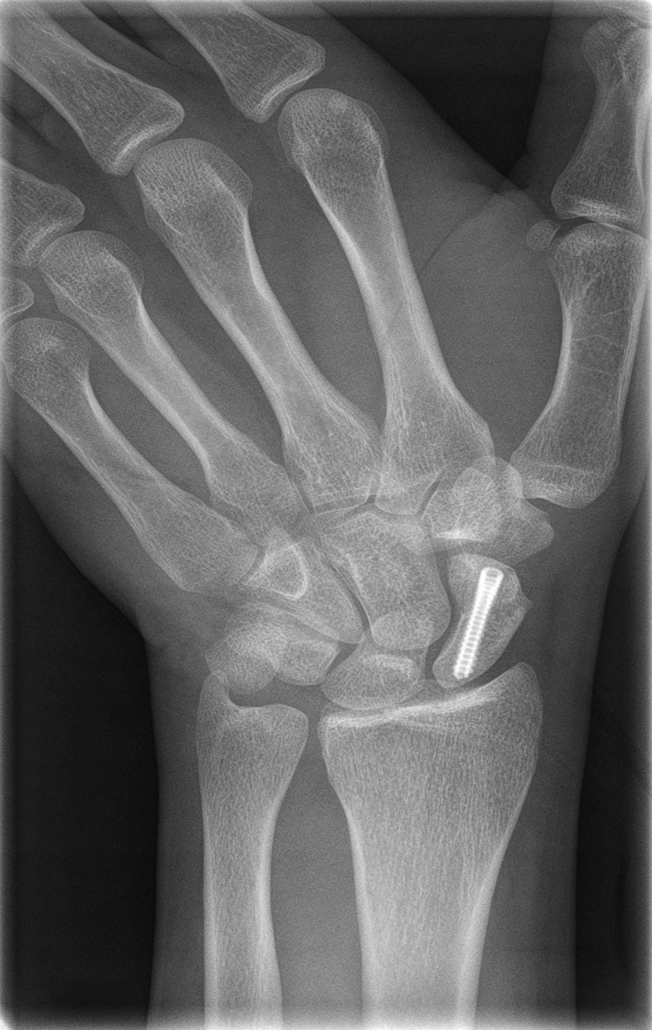Scaphoid fractures treated with a volar percutaneous approach. Analysis ...