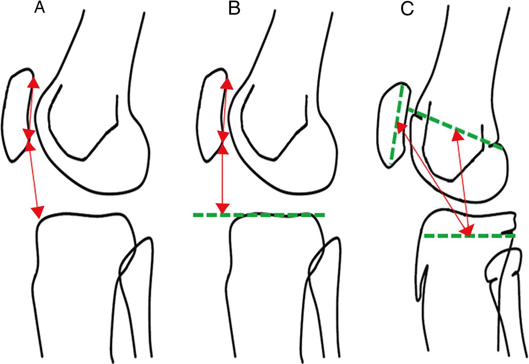 Normal values of 3 methods to determine patellar height in children ...