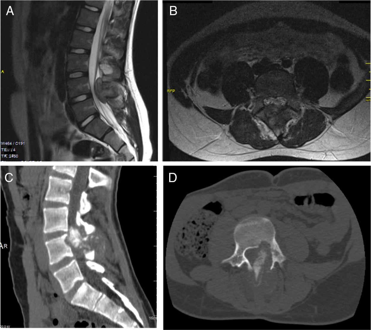Spinal osteosarcoma in the paediatric age group: Case series and ...