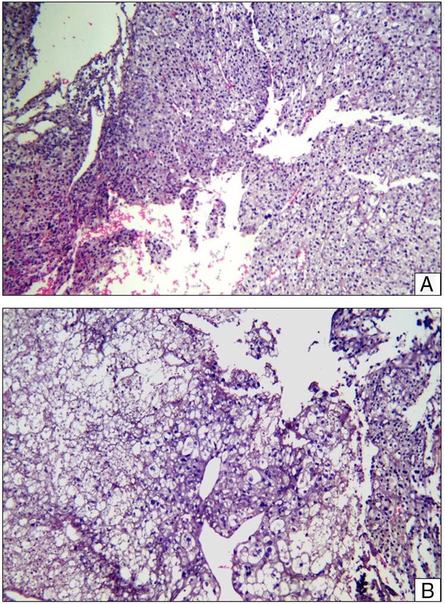 Tibial perivascular epithelioid cell tumour (PEComa). A case report and ...