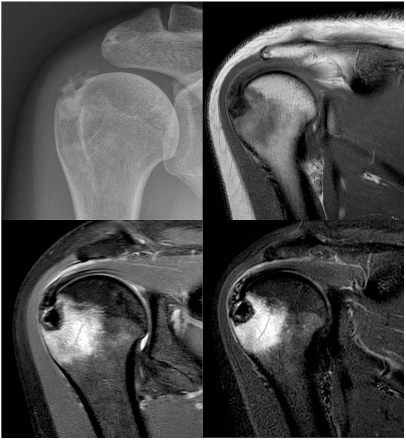 Calcific tendinopathy of the shoulder with intraosseous extension ...