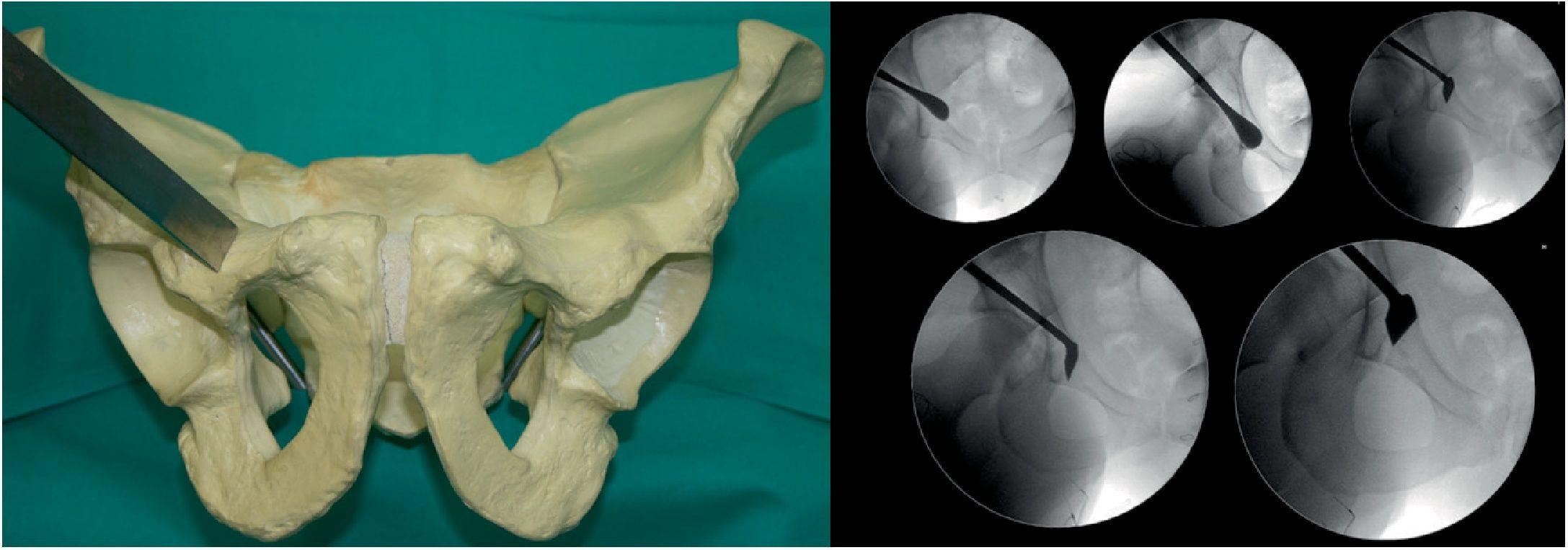 Periacetabular osteotomy for hip dysplasia treatment through a mini ...