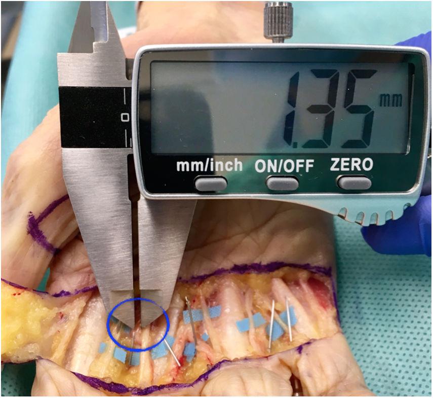 Dorsal web injection technique in the treatment of trigger finger and ...