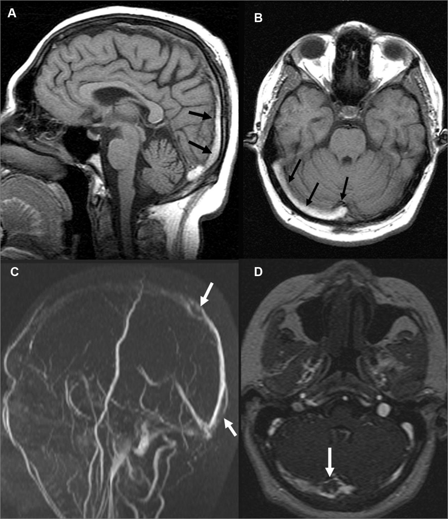 Superior Sagittal Sinus Thrombosis