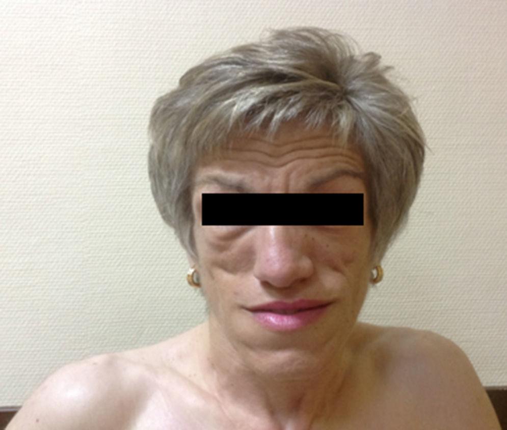 Berardinelli-Seip syndrome in peritoneal dialysis | Nefrología