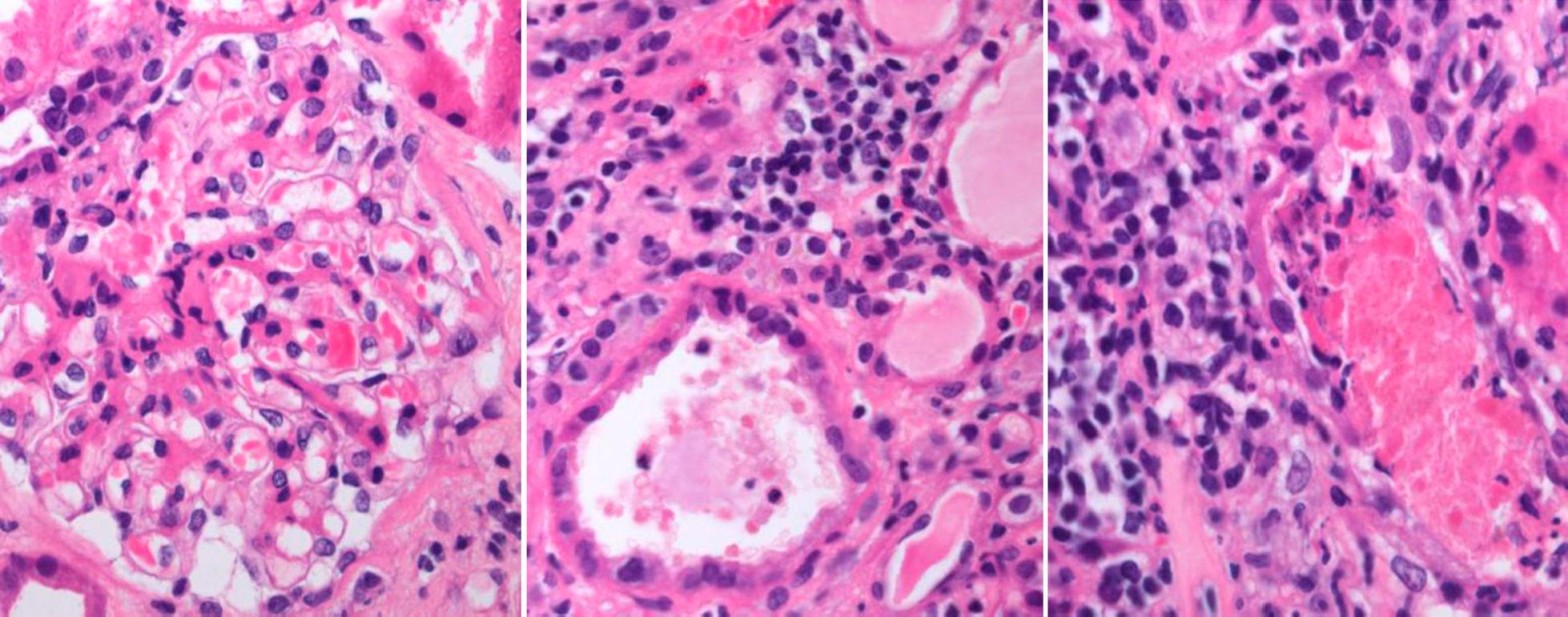 IgA nephropathy associated with acute interstitial nephritis after ...