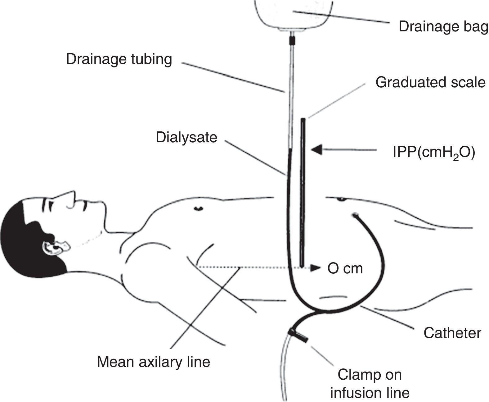 Intraperitoneal pressure in peritoneal dialysis | Nefrología