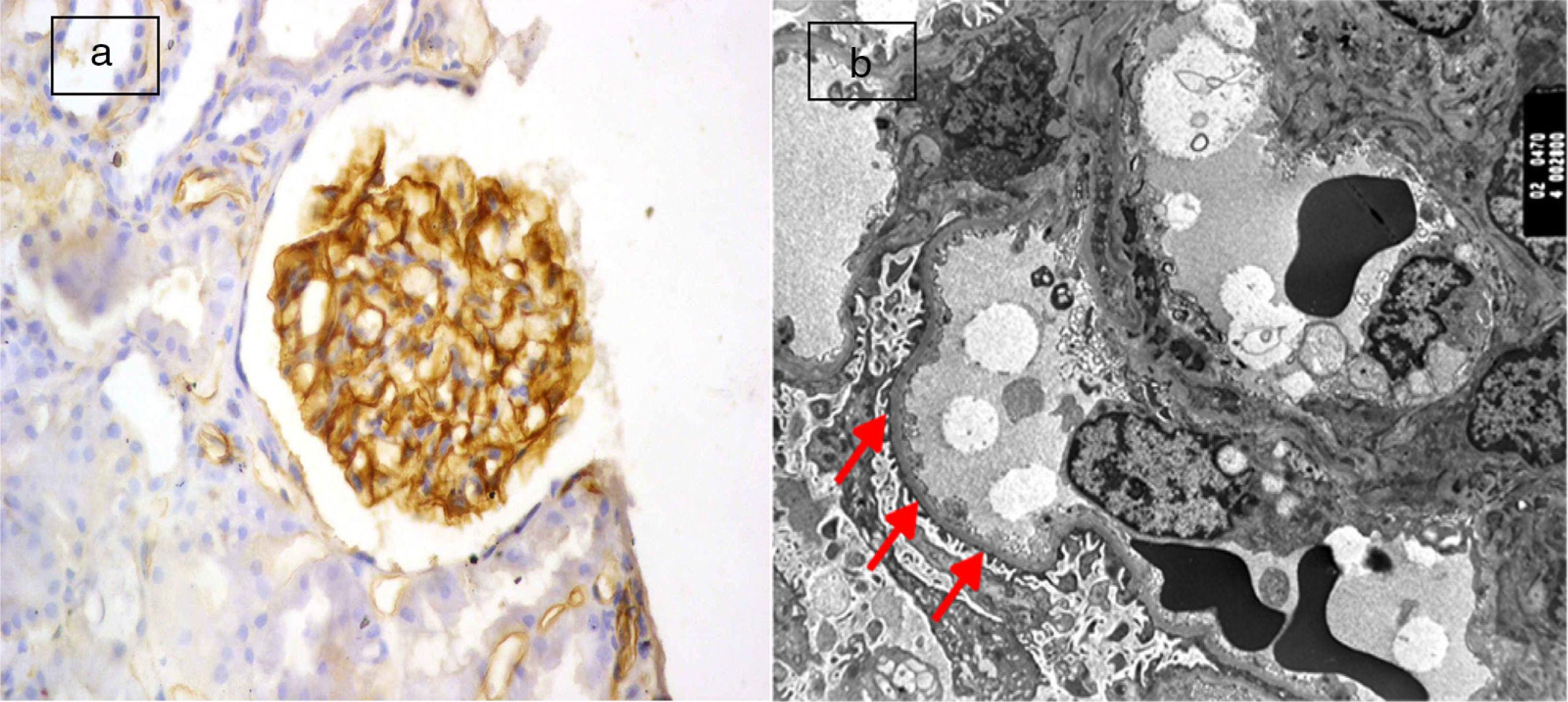 Value of immunohistochemical expression of podocalyxin in active lupus ...