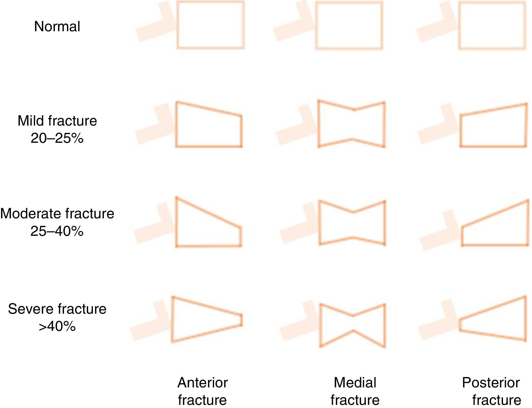Osteoporosis, bone mineral density and CKD–MBD complex (I): Diagnostic ...