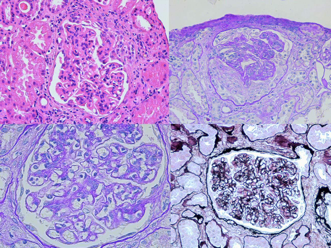IgA dominant postinfectious glomerulonephritis secondary to cutaneous ...