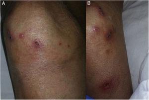 Crateriform plaques in a patient with end-stage renal disease. The case ...