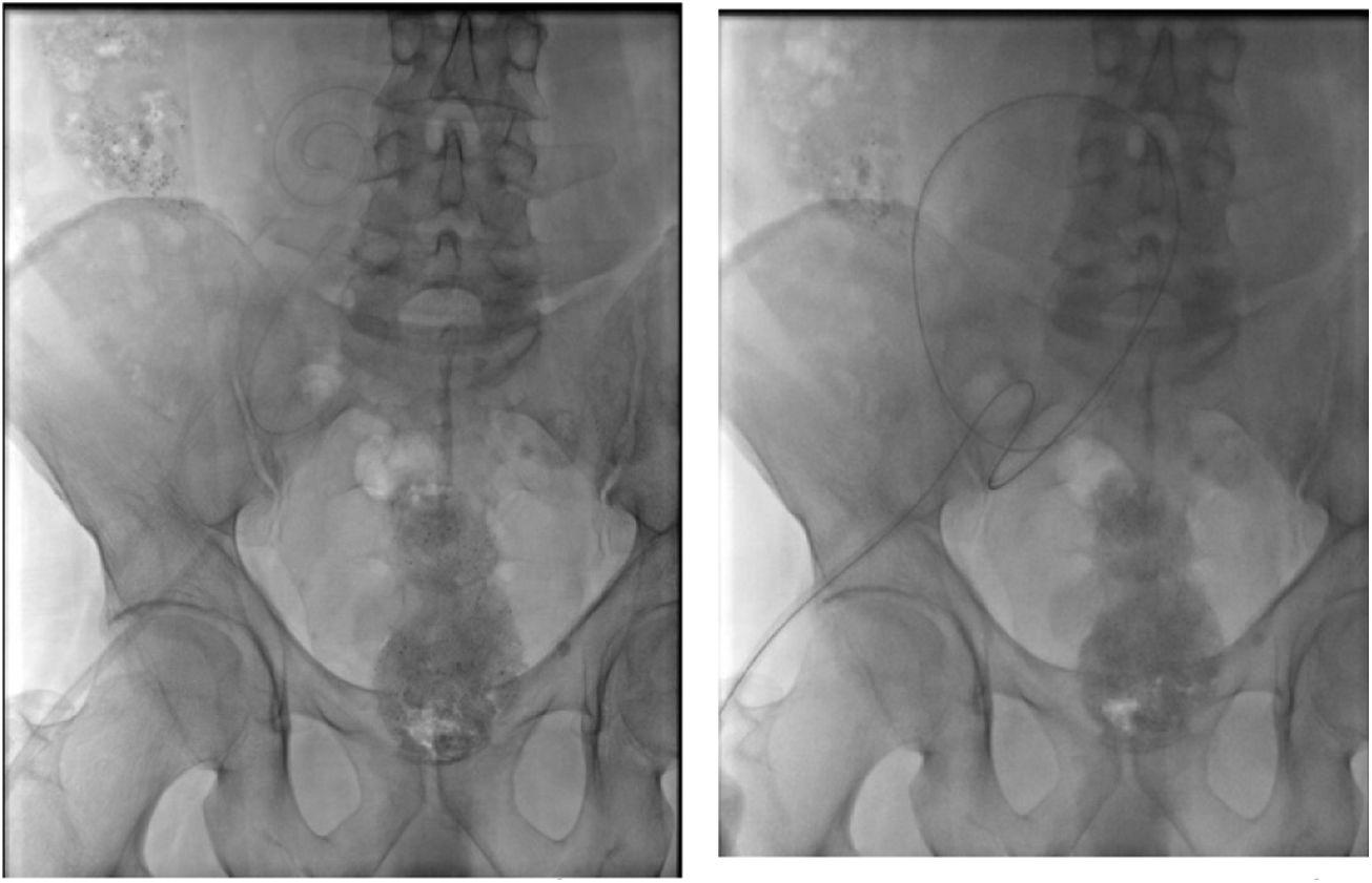 Usefulness of the alpha maneuver in the peritoneal catheter ...