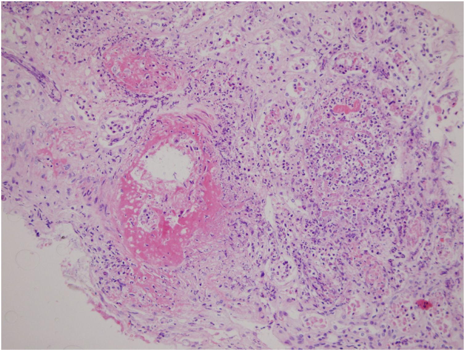 Pauci-immune necrotizing glomerulonephritis in a patient with ...