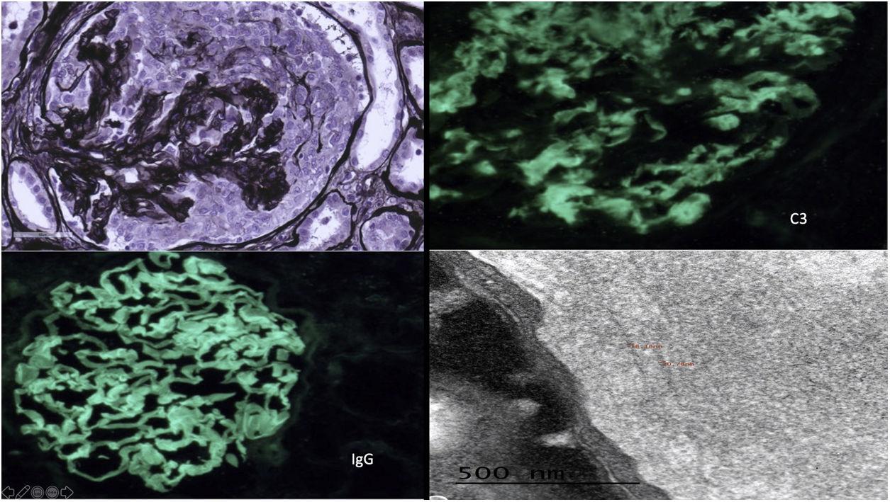 Fibrillary glomerulonephritis simulating glomerular basal antimembrane ...