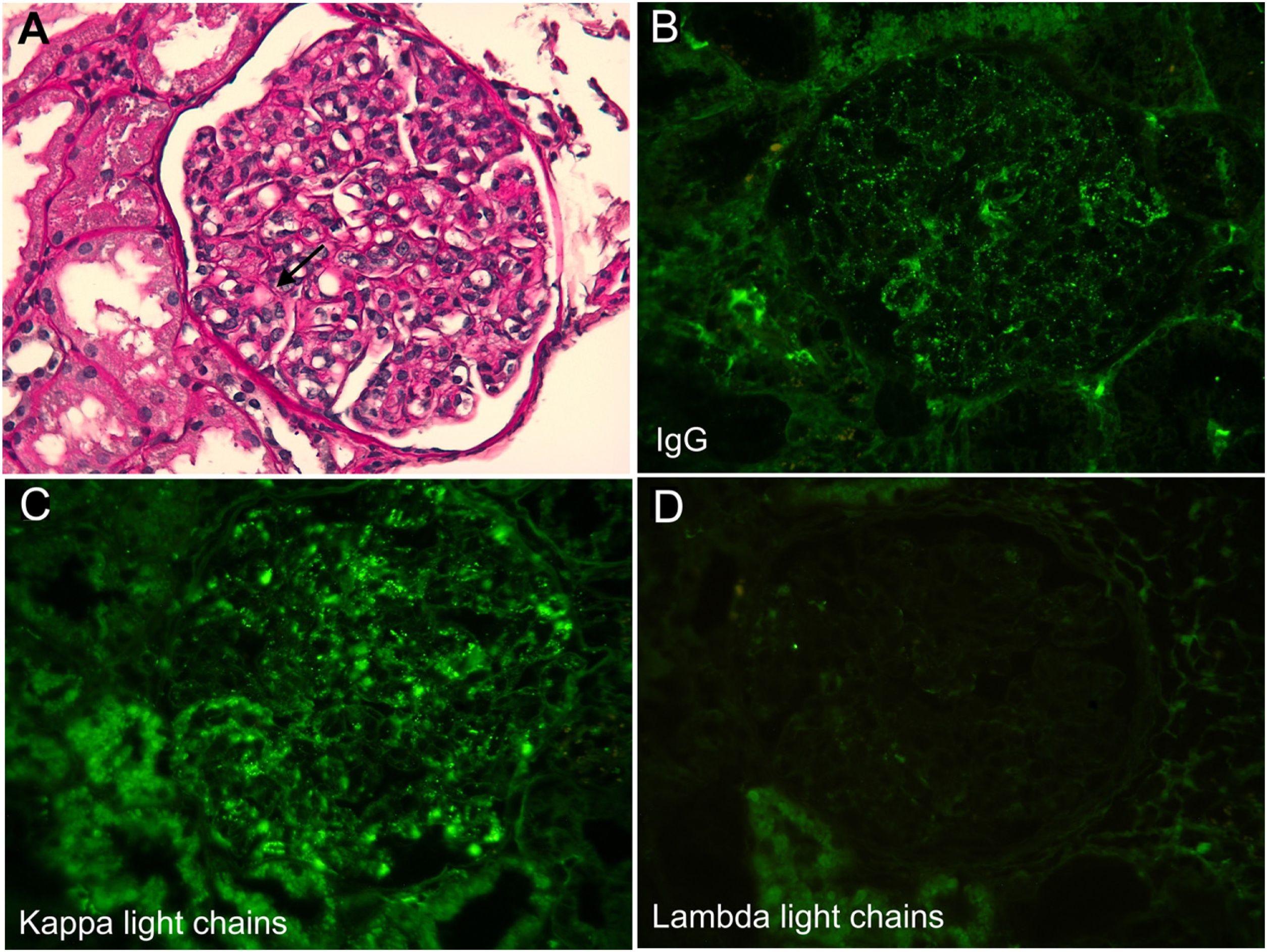 Revisiting Schnitzler syndrome: A rare severe form of acute kidney ...