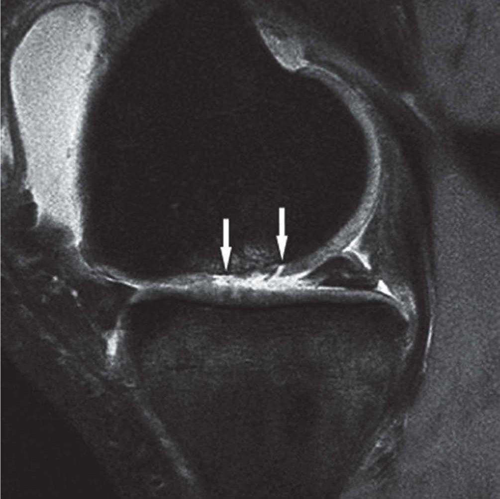 Lesiones del cartílago articular de la rodilla mediante resonancia ...