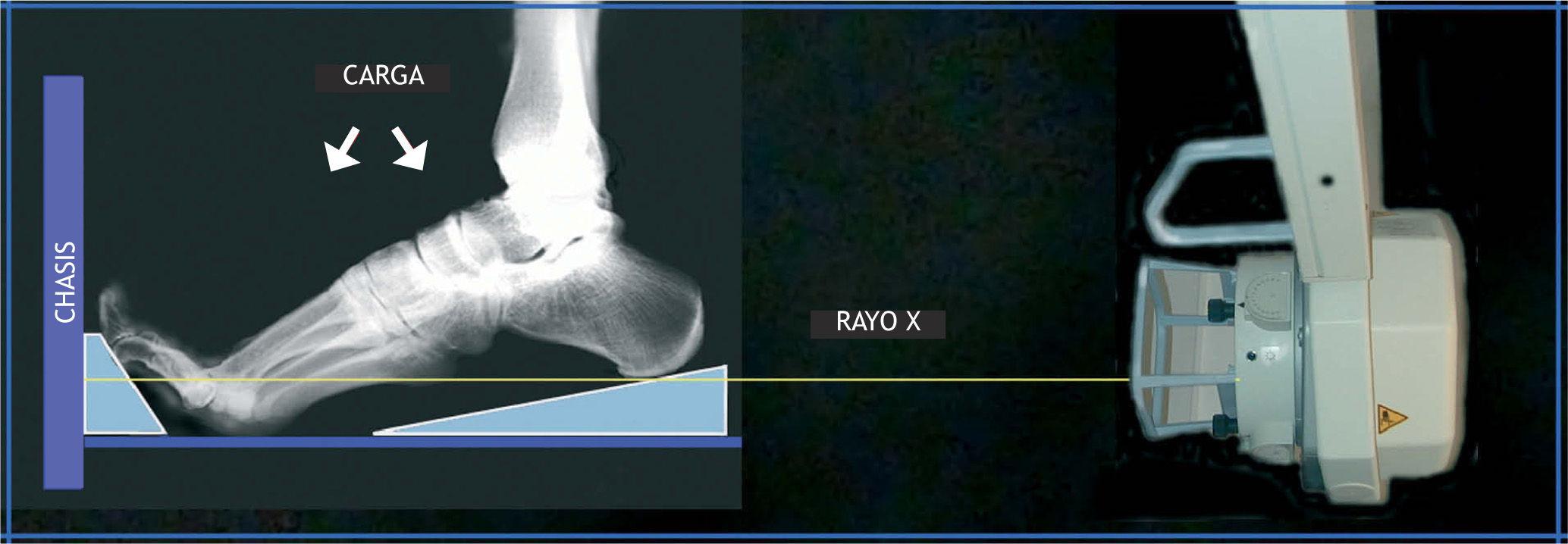 Estudio en axial de las cabezas metatarsales y huesos sesamoideos en la ...