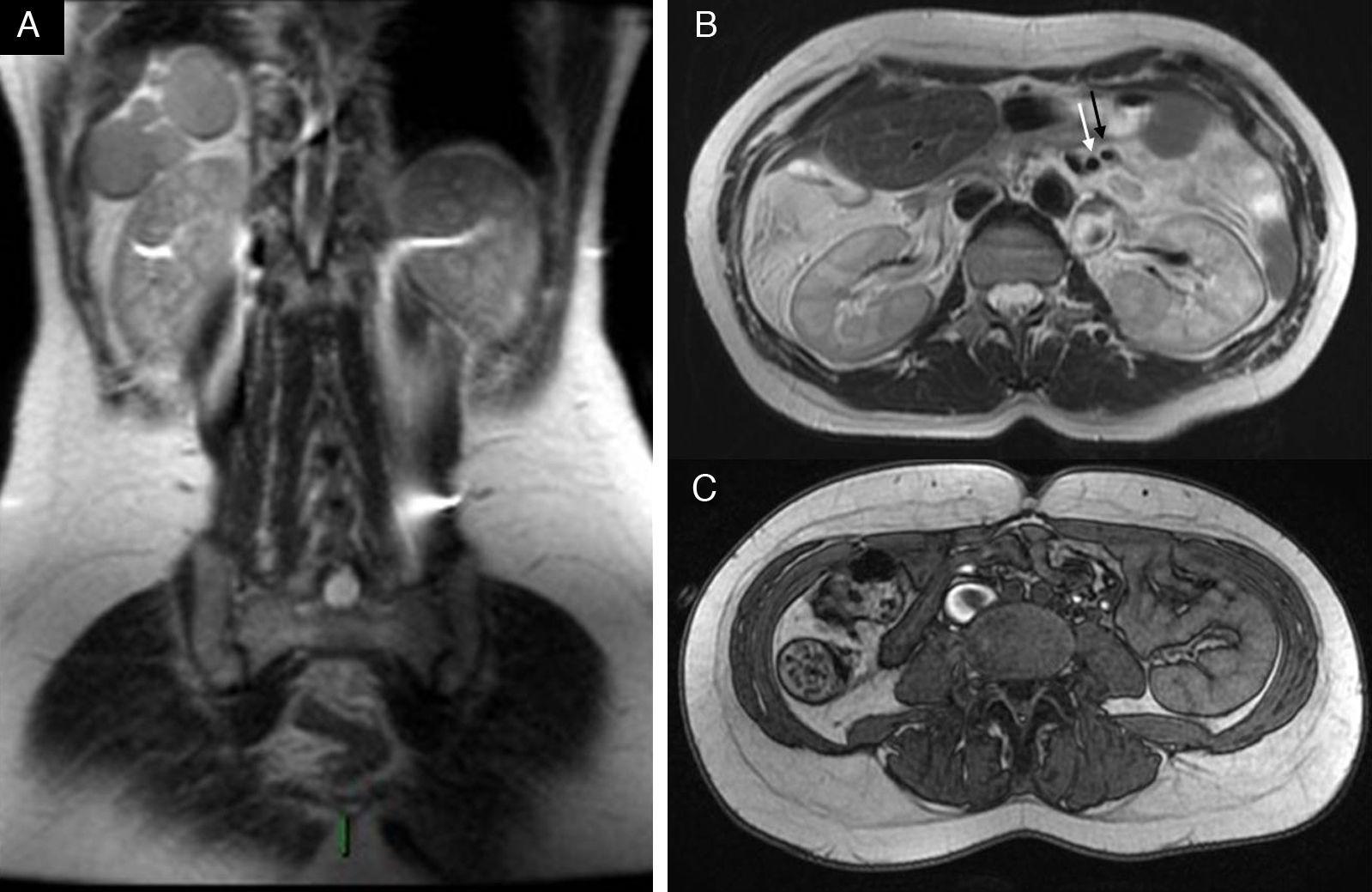 Hallazgos radiológicos por ecografía y resonancia magnética en un ...