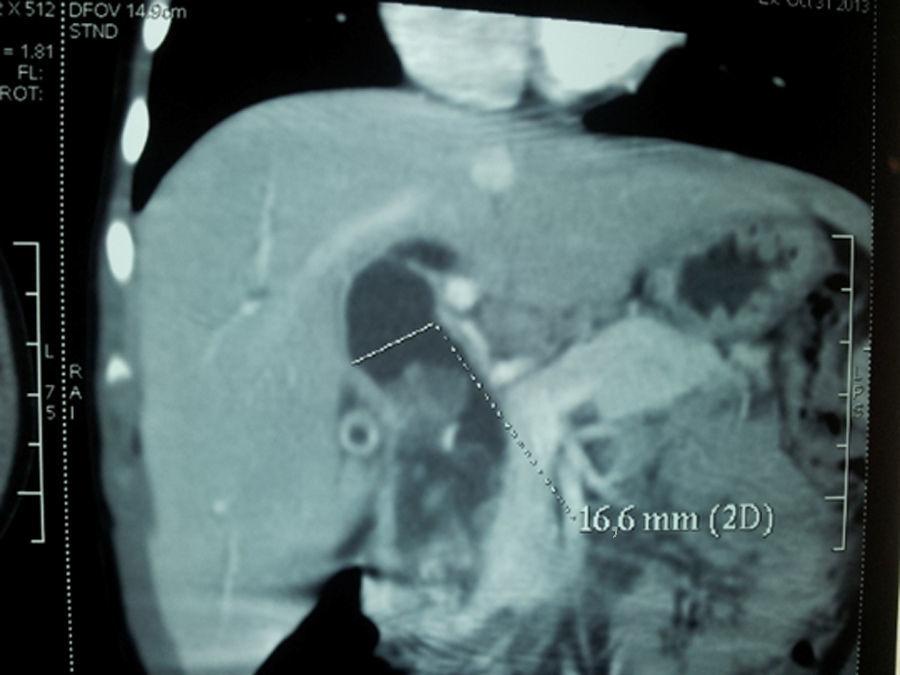Reporte de caso. Rabdomiosarcoma botrioides de la vía biliar | Imagen ...