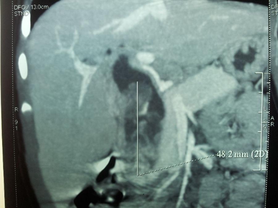 Reporte de caso. Rabdomiosarcoma botrioides de la vía biliar | Imagen ...