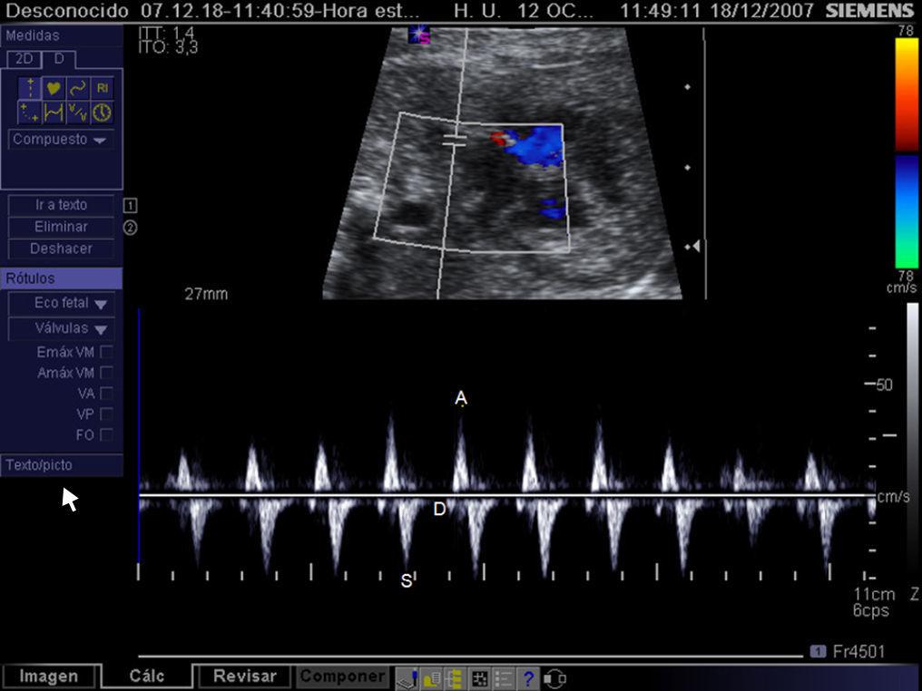 Intervencionismo cardiaco fetal | Diagnóstico Prenatal