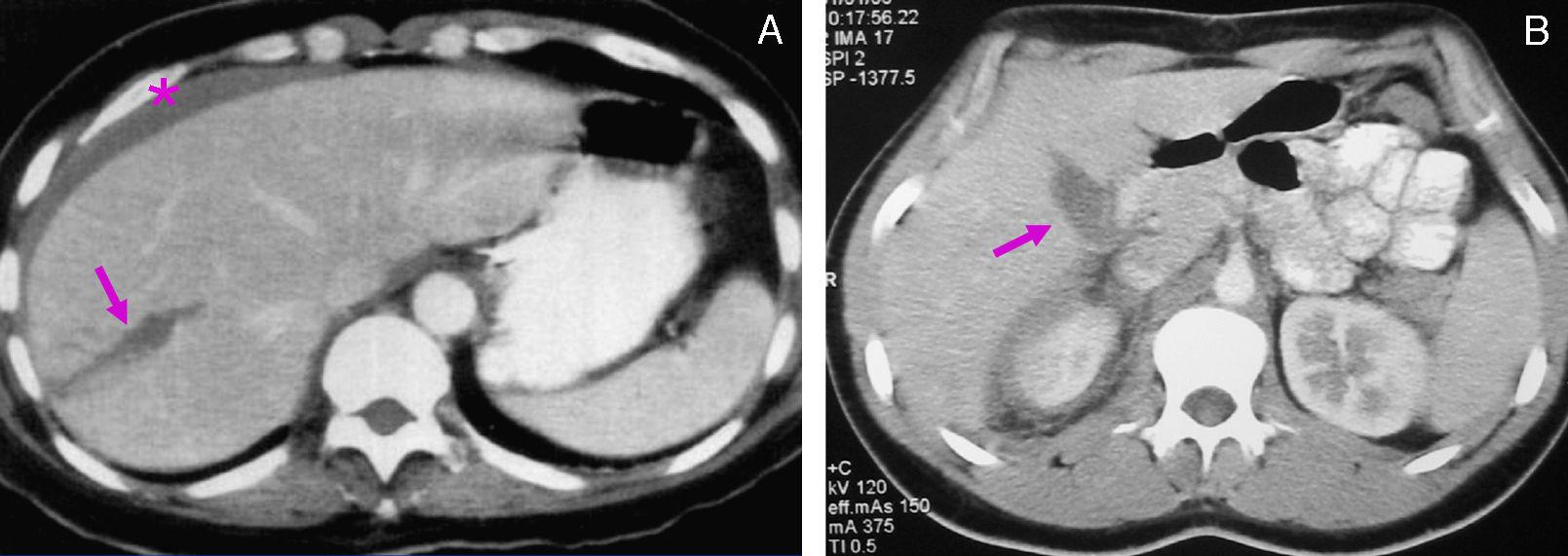 Changes in the Diagnosis and Therapeutic Management of Hepatic Trauma ...