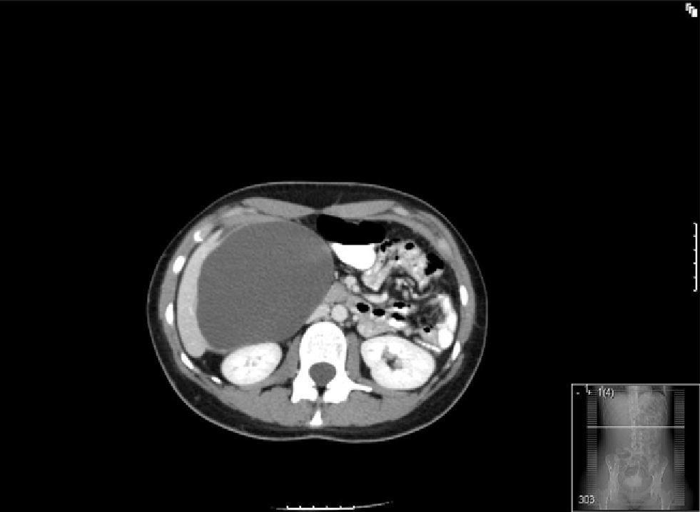 Cystic Hepatic Lymphangioma: A Rare Cause of Abdominal Pain in the ...
