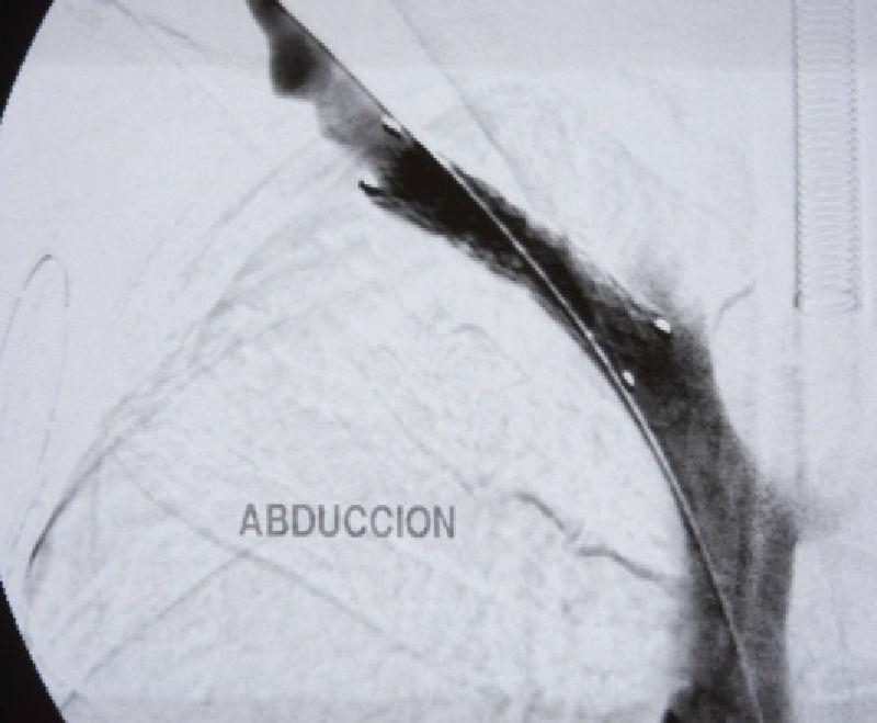 Paget–Schroetter Syndrome | Cirugía Española (English Edition)