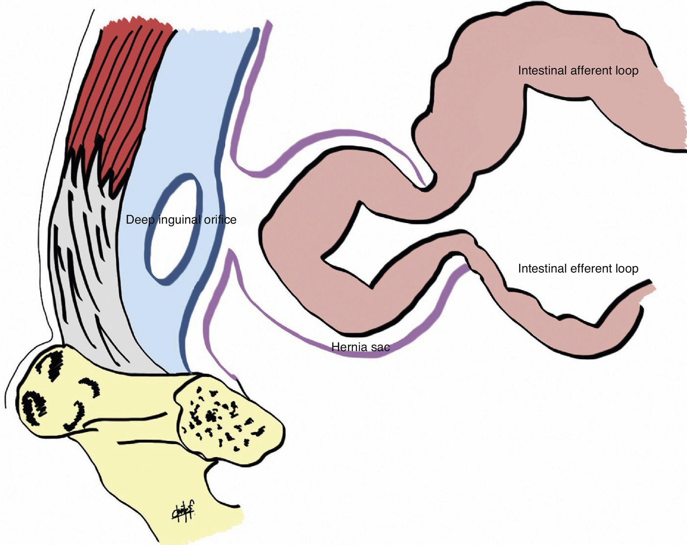 En Masse Reduction of an Incarcerated Inguinal Hernia. Emergency ...