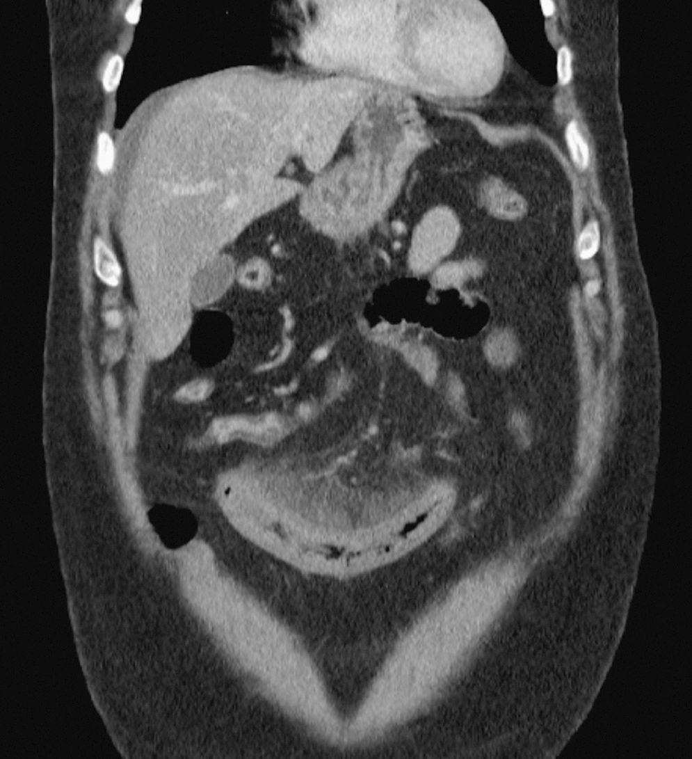 Acute Mesenteric Ischemia Caused by Venous Thrombosis in a Patient With ...