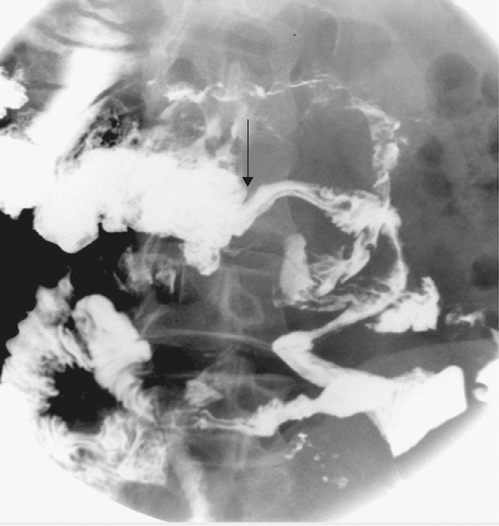 Unusual Intestinal Malrotation in an Adult | Cirugía Española (English ...