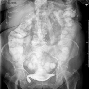 Colo-uterine Fistula Due to Colonic Diverticulitis. Incidental ...